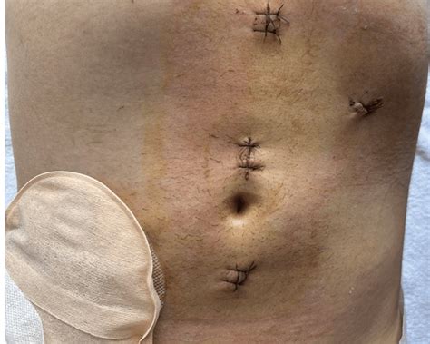 Robot Assisted Multiquadrant Operation Proctocolectomy And Abdominoperineal Resection Using The