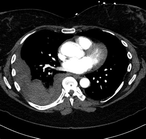 Axial Contrast Enhanced Ct Of The Chest 2 Mm Slice Thickness 100 Ml