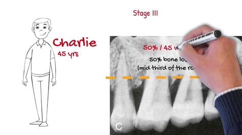 The New Periodontal Classification Must Watch For All Dentists Youtube