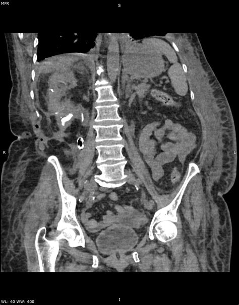 Emphysematous Pyelonephritis Image