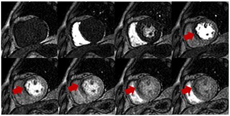 Myocardial Perfusion Imaging