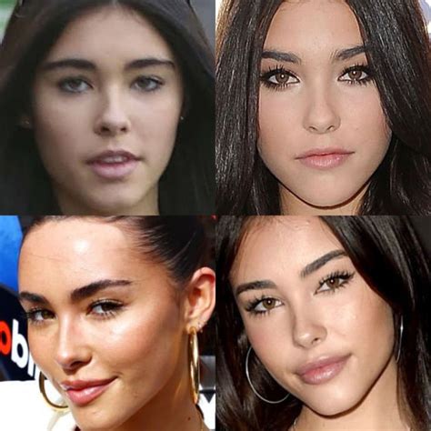Madison Beer Plastic Surgery Cindy Kimberly Lip Filler Russian