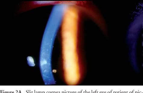 Figure 1 From Posterior Polymorphous Dystrophy And Keratoconus More Than A Casual Association