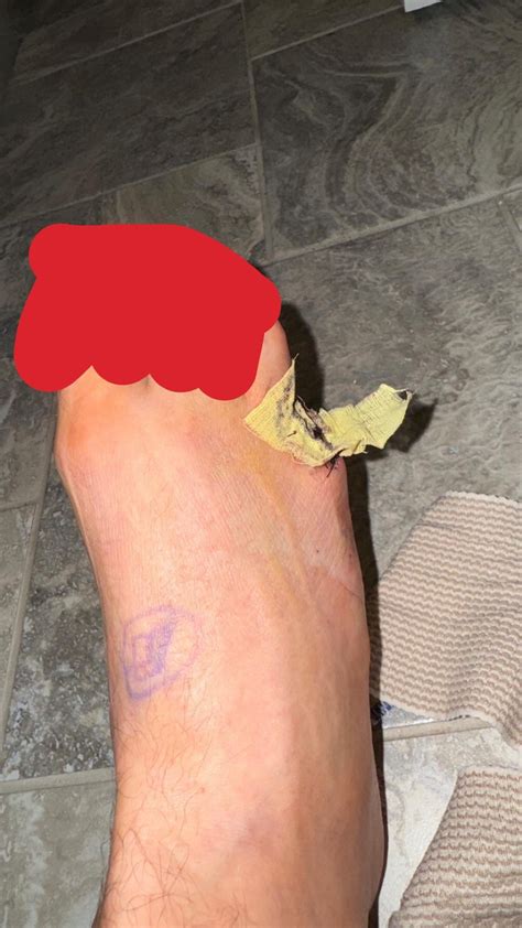 Final Toe Amputation Update Rmedicalgore