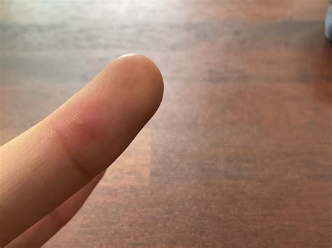 손가락에 여드름 같은게 났어요 아 지식in