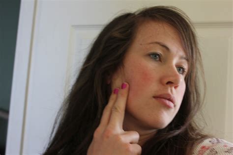 swollen lymph node in front of ear