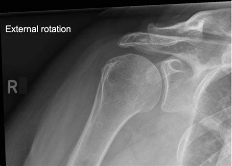 Normal Shoulder Buyxraysonline