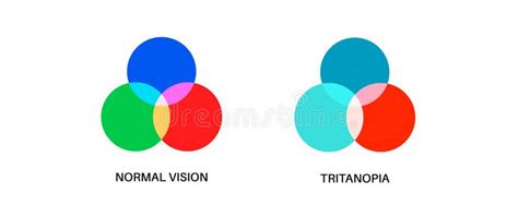 Tritanopia And Tritanomaly Stock Vector Illustration Of Medical 307345229