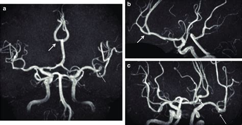 A Mra Shows An Aneurysm Of The Mca At The Left Bifurcation Long Download Scientific Diagram
