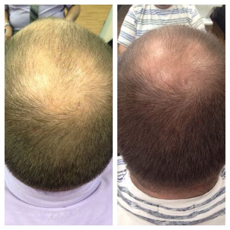 Nioxin Hair Growth Before And After Kkbt