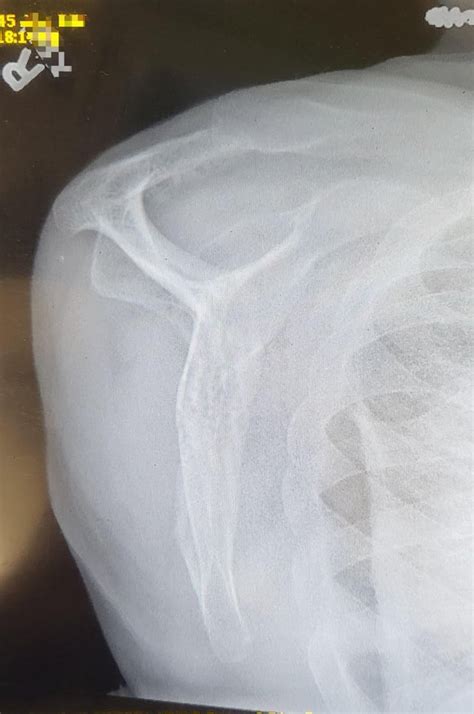 If You Struggle With Scap Y Lateral Scapula R Radiology