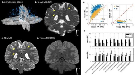 Investigating The Effect Of The Perivascular Space Pvs On Dti In