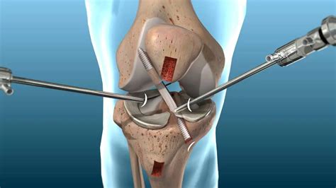 Acl Treatment In Villivakkam Acl Reconstruction Doctor Acl Surgery In Villivakkam