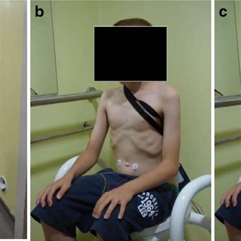 Uroflow Curve Patterns A Bell Shaped Normal B Tower Shaped