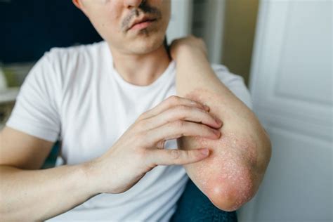Guidelines On Atopic Eczema Provide Treatment Recommendations For