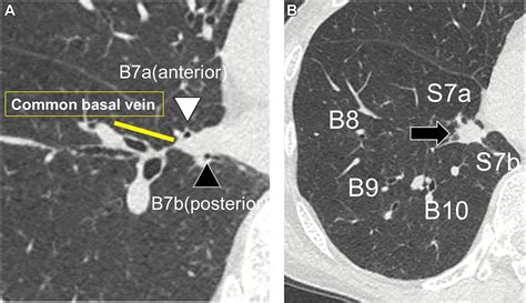 Thoracoscopic Anatomic Segmentectomy Techniques For Rare Medial Basal