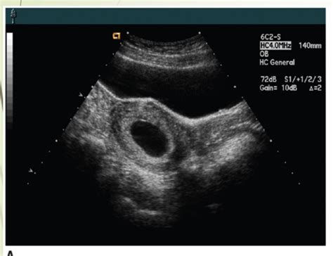 Sonographic Evaluation Of First Trimester Complications Sec Charlotte Flashcards Quizlet
