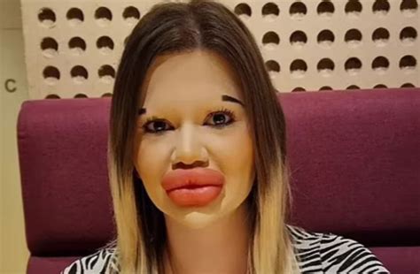 Fans Fear For The Life Of Woman With The Worlds Biggest Lips Andrea