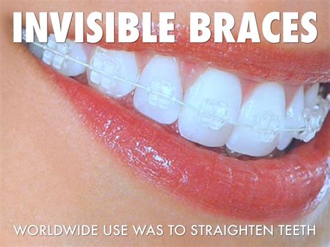 Invisible Braces Nasa