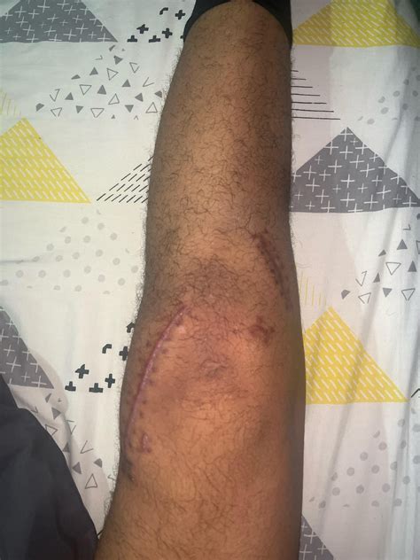 6 Weeks Post Op Acl Let R Acl