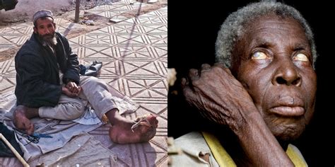 15 Weird Af Diseases You Can Catch In The Tropics Therichest
