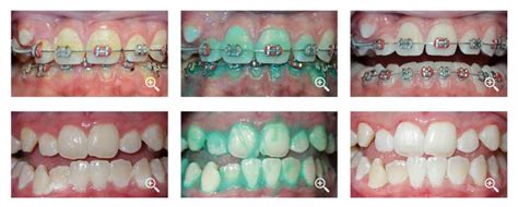 Plaque Hd Toothpaste With Targetol Technology Plaque Identifying