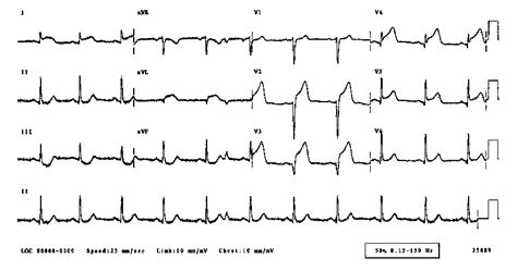 Acute Anterior Myocardial Infarction Medical Liberary