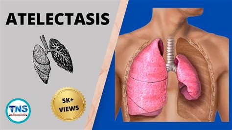 Atelectasis Pathophysiology Diagnosis Prevention Nursing Management The Nurses