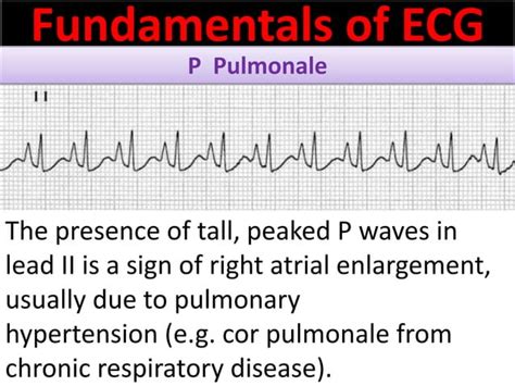 P Wave Abnormalities In Ecg Ppsx Heart And Cardiovascular Diseases