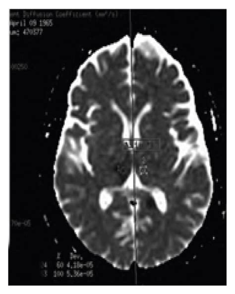 ADC Diagram Obtained By Scanning Parameters Of AIS Patients Download Scientific Diagram