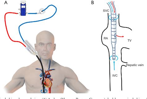 vv ecmo cannula placement