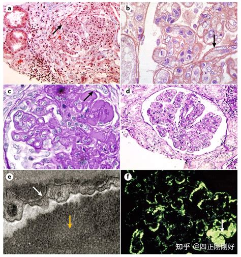 冷球蛋白血症—nature Review文章阅读 知乎