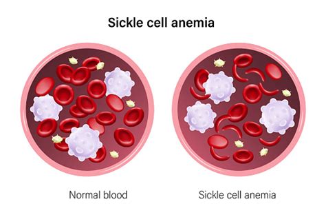 겸상적혈구 빈혈 혈액 겸상적혈구 빈혈및 정상 혈액의 차이 적혈구 백혈구 및 혈소판 겸상적혈구빈혈증에 대한 스톡 벡터 아트 및 기타 이미지 겸상적혈구빈혈증 헤모글로빈