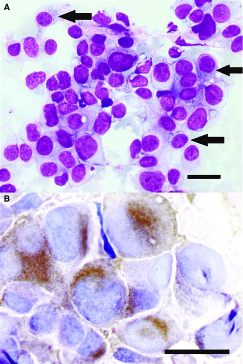 Amelanotic Melanoma Cytology