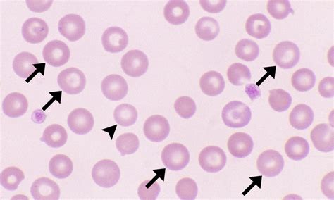 Macrocytes Cells And Smears