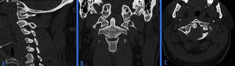 Computed Tomography Scan Shows C1 Jefferson Burst Fracture Extending To Download Scientific