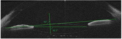 Iol Tilt Measured On Ss Oct Image The Reference Line Was Determined As Download Scientific