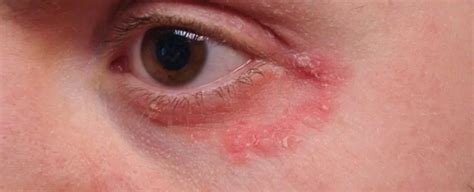 Красные пятна на лице причины Coolaser Clinic