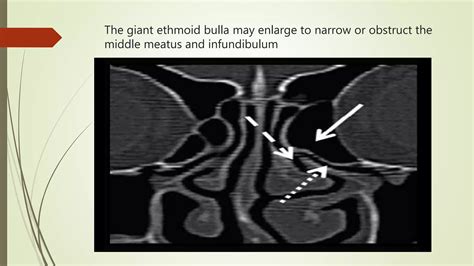 Surgical Anatomy Of Osteomeatal Complex Pptx