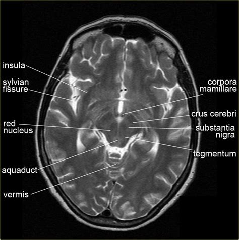 Sylvian Fissure Mri