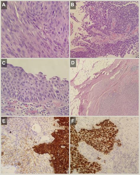 A Spindle Cell Tumour In The Bladder Diagnostic Histopathology