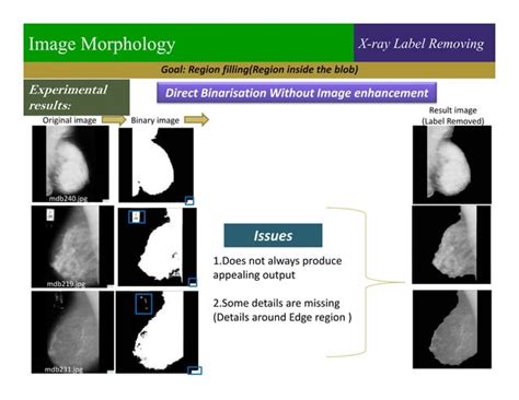 Microcalcification Identification In Digital Mammogram For Early