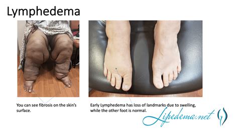 Lymphedema Vs Lipedema Lipedema