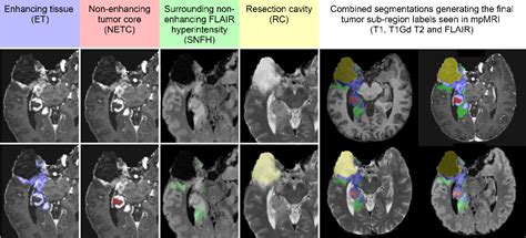 The 2024 Brain Tumor Segmentation Brats Challenge Glioma
