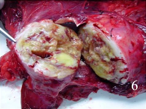 Tumor Surgery Gt Tumor Education Gt Soft Tissue Tumors Soft Tissue