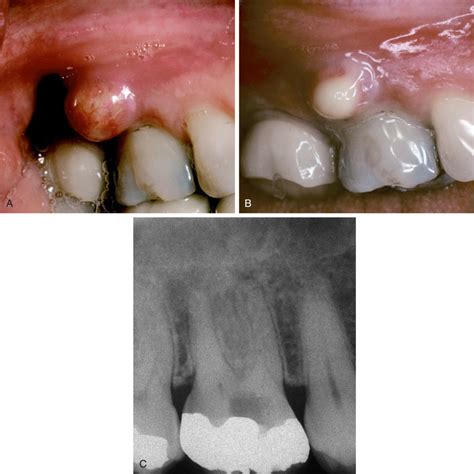 Endodontic Diagnosis Aae At Ruth Madison Blog