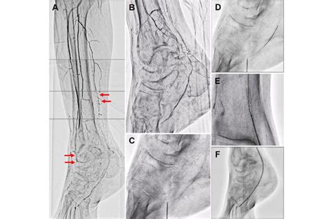 A Initial Angiography Showing Occlusions Of The Distal Anterior Tibial