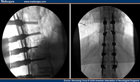 Fusion Techniques Lumbar Surgery