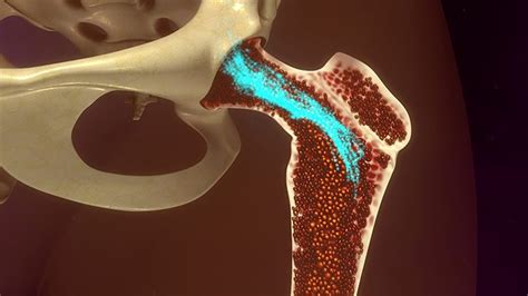 Everything You Need To Know About Al Amyloidosis Everyday Health