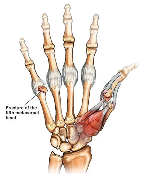 Boxers Fracture Metacarpal Fracture Diagnosis Causes And Treatment